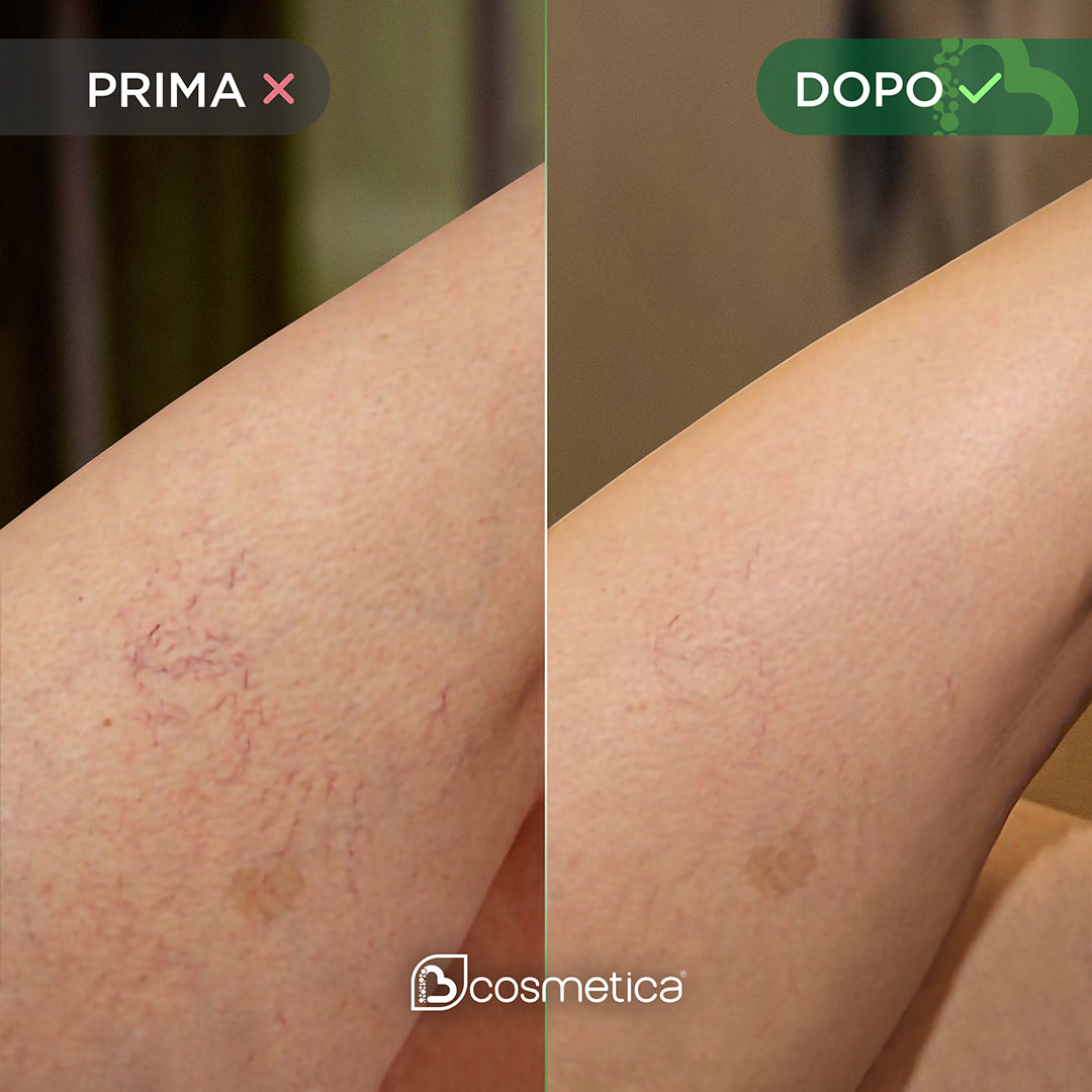 Venum Trattamento Vene Varicose e Capillari con Lattoferrina, Bromelina ...