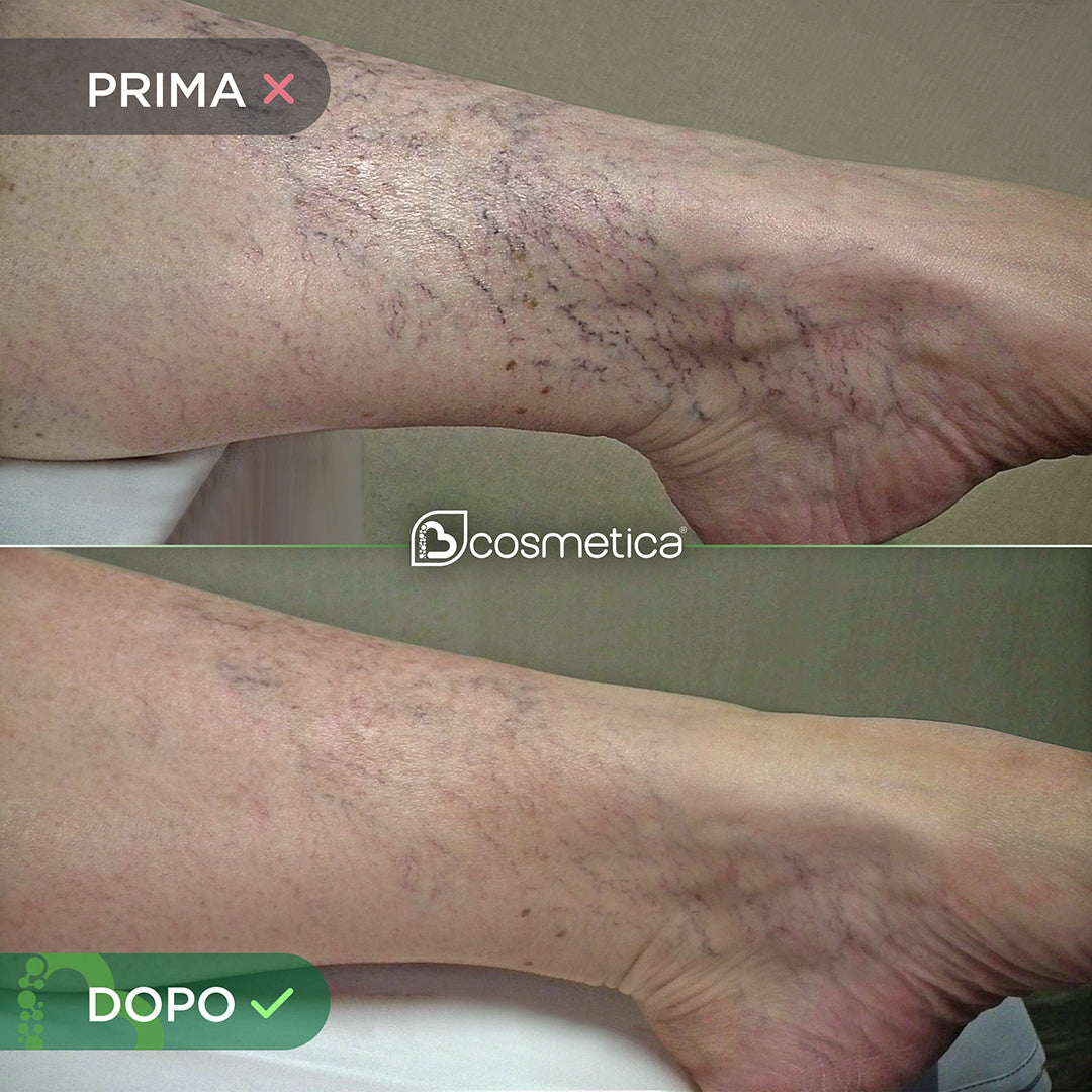 Venum Trattamento Vene Varicose e Capillari con Lattoferrina, Bromelina ...